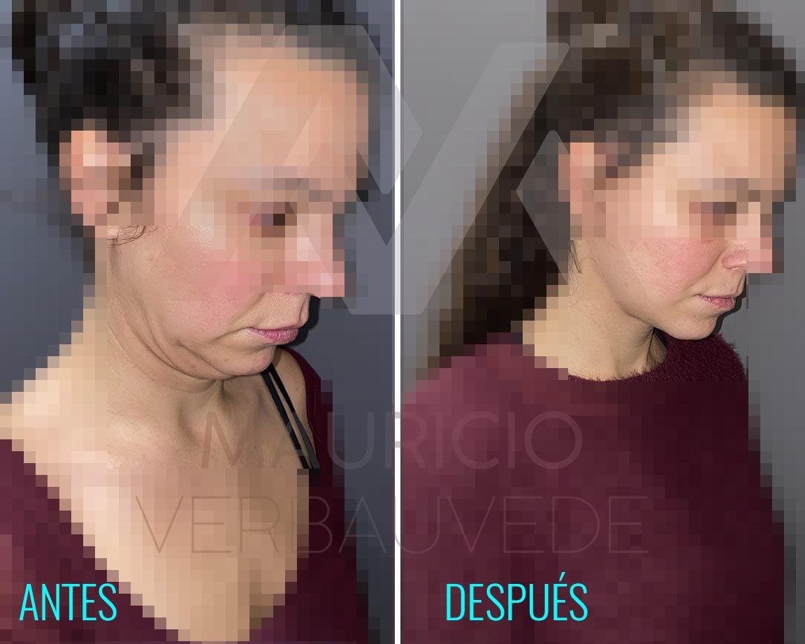 Minilifting facial – Clinica Verbauvede
