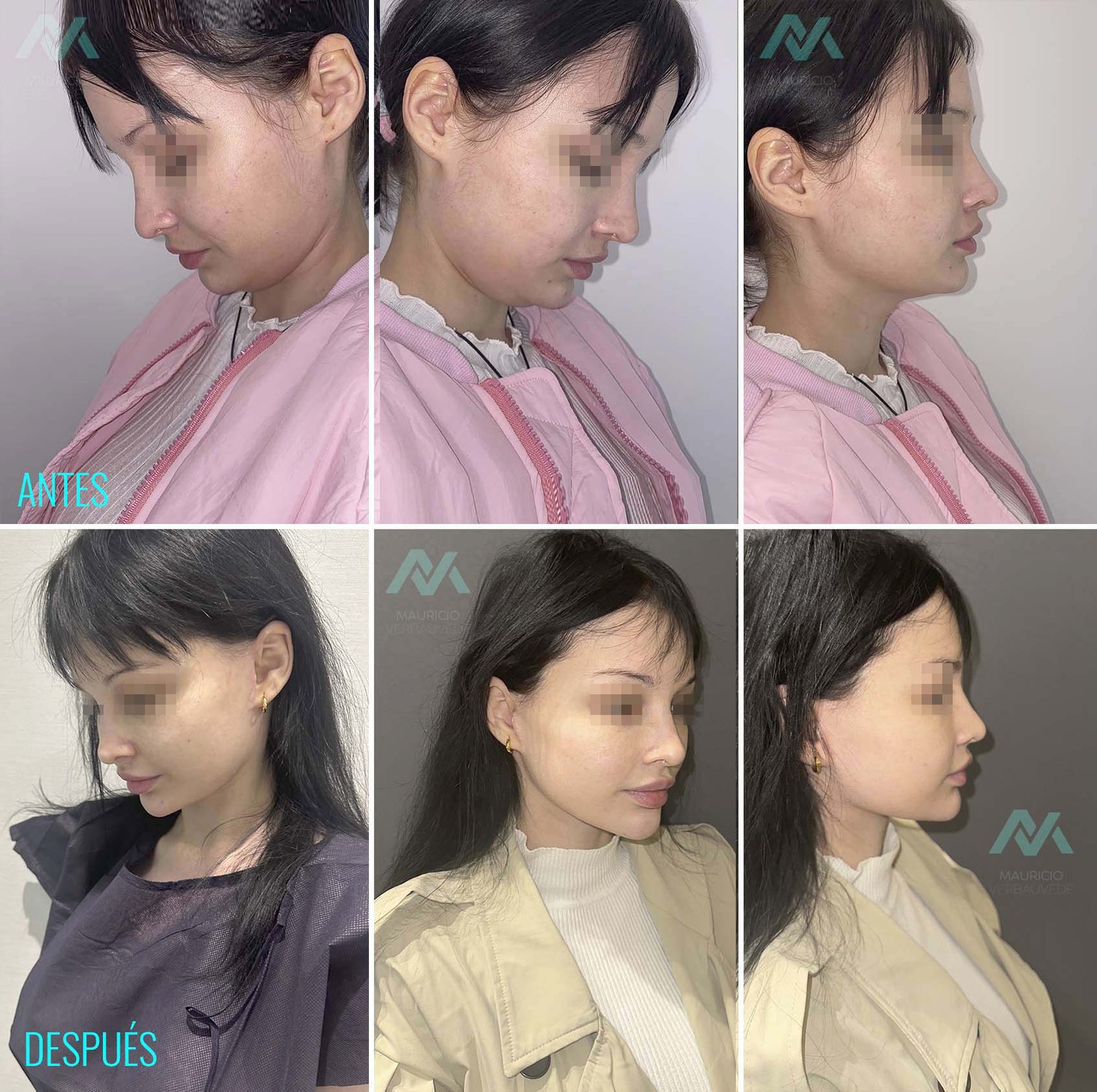 Minilifting facial | Refresca y rejuvenece tu rostro